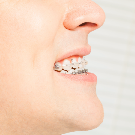 Retainers: Types, Purpose, How They Work, Costs, Cleaning & Removal